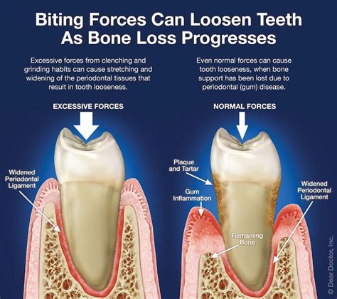 Loose Teeth Bite Problems Coastal Periodontics Implant Dentistry