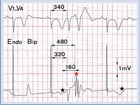 Figure 3 From Fragmented Endocardial Signals And Early Afterdepolarizations During Torsades De
