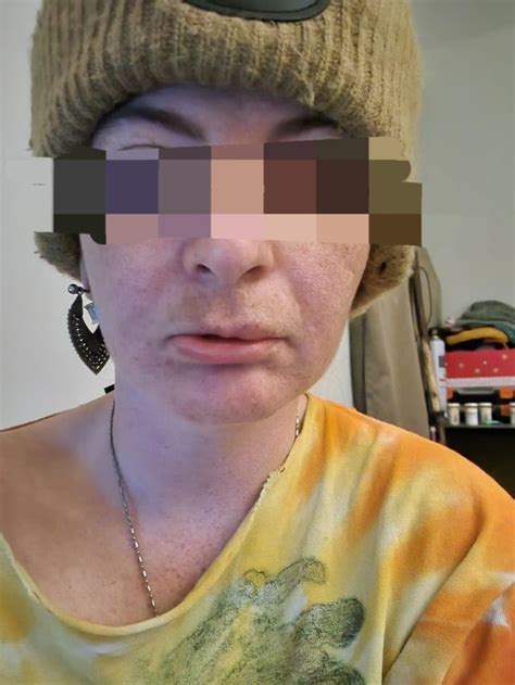Any One Else Have Facial Swelling Rlupus