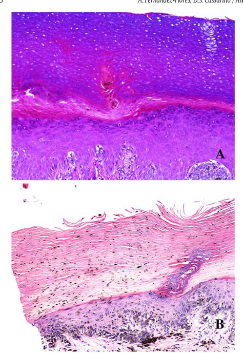Figure 6 From Histopathological Diagnosis Of Acral Lentiginous Melanoma
