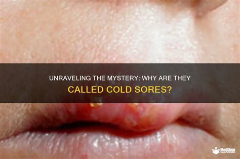 Unraveling The Mystery Why Are They Called Cold Sores Medshun