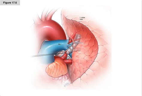 Pulmonary Lobectomy Thoracotomy And Vats Springerlink
