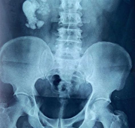 Dioramaduniaku Membaca Rontgen Toraks Normal