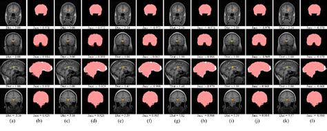 Figure 1 From Unsupervised End To End Learning For Deformable Medical Image Registration