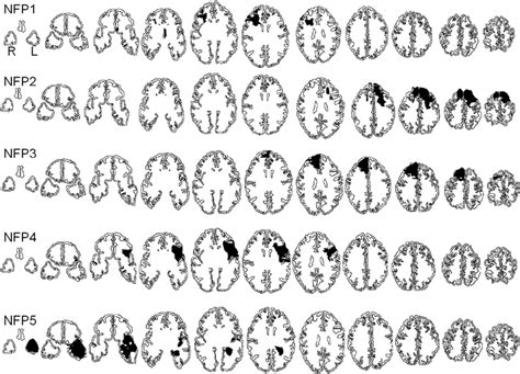 Reconstruction Of Lesions For Each Patient Without Frontopolar Cortex