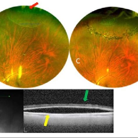 A Temporal Lesion Consistent With Wwop Black Arrow B Oct Scans Download Scientific Diagram