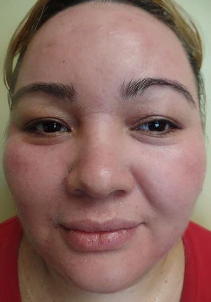 Before And After Hyperpigmentation Dr Nguyen Health Center