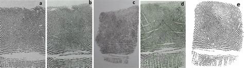 a an unusual fingerprint pattern named as a central pocket whorl b an