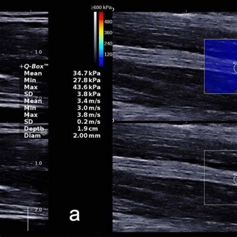 Short Axis View Shear Wave Elastography With Color Map Minimum Download Scientific Diagram