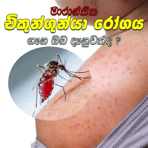 Isiwara මාරාන්තික කුන්ගුන්යා වෛරසය ගැන ඔබ දැනුවත්ද කුන්ගුන්යා වෛරස්