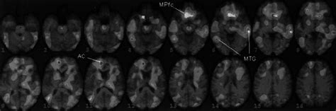 Statistical Parametric Map Overlaid On A Magnetic Resonance Image Download Scientific Diagram