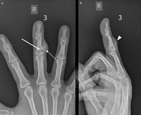 Juxta Cortical Chondroma Of The Phalanges Is There A Role For Cone