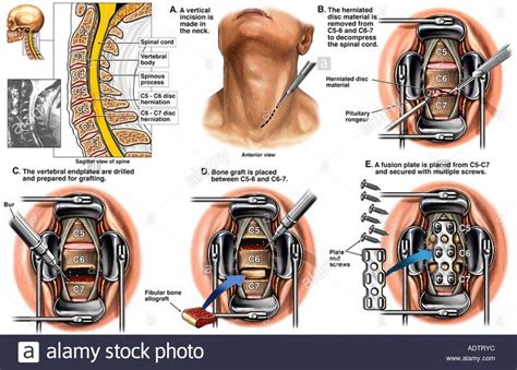 Download This Stock Image Spine Surgery C5 6 And C6 7 Anterior