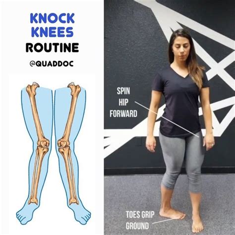 Genu Valgum Exercises