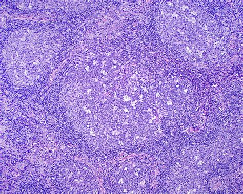 Pathology Outlines Reactive B Cell Rich Lymphoid Proliferations That Can Mimic Lymphoma