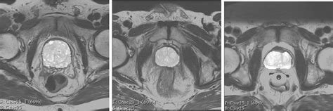 Figure 2 From 3d Prostate Segmentation From Mr Images Using Fcnn Semantic Scholar