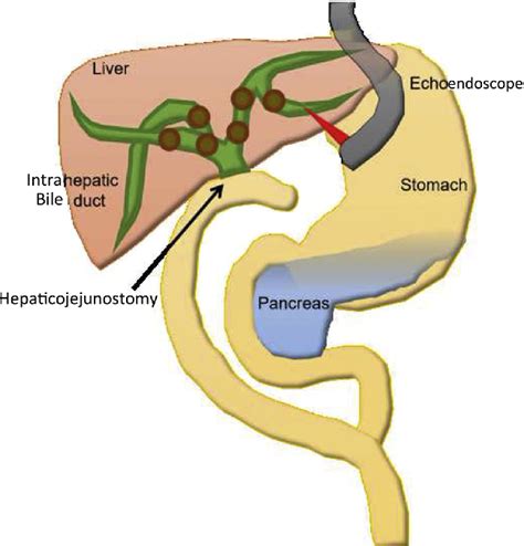 Figure 2 From Electrohydraulic Lithotripsy Through A Fistula Of Eus
