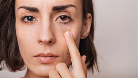 Ojos Irritados Causas Y Tratamientos Opeluce