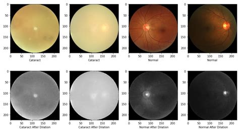 cataract detection using ml let s create an ml model to classify an