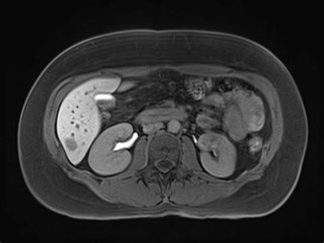 Hepatic Adenomatosis With Eovist Mri Body Mr Radiology Case Studies