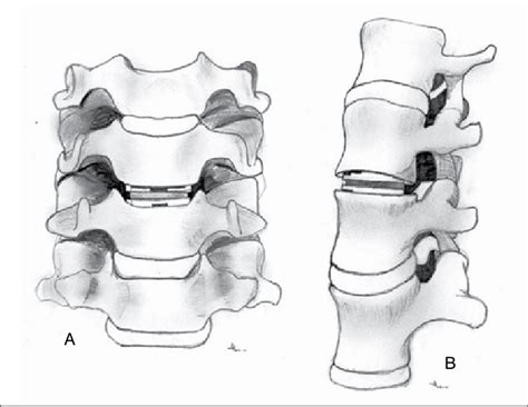 Cervical Disk Arthroplasty A And Lumbar Disk Arthroplasty B