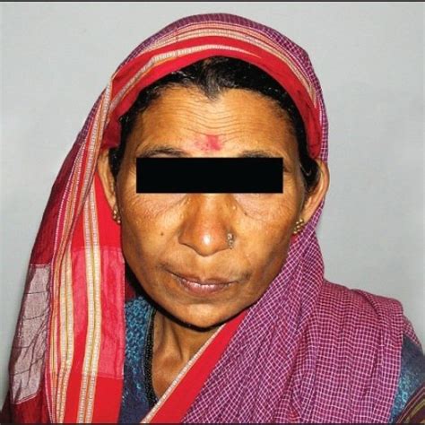 Facial View Showing The Extraoral Diffuse Swelling Download