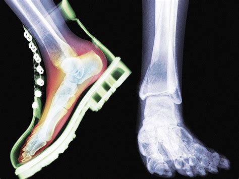Ankle Replacement Surgery Procedure And Recovery
