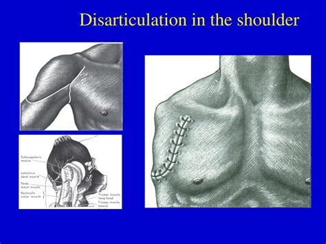 Ppt Amputation Powerpoint Presentation Free Download Id9490838