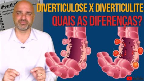 Sangramento Por Diverticulose Quiz Profilaxia De Sangramento