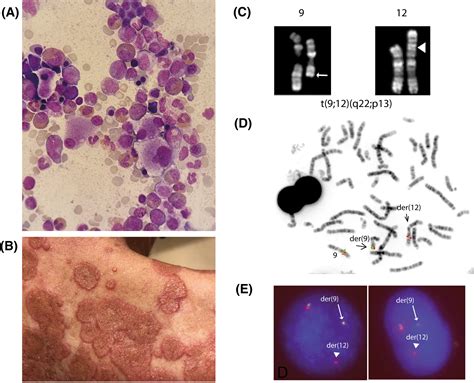 T912q22p13 Etv6syk A New Recurrent Cytogenetic Aberration And