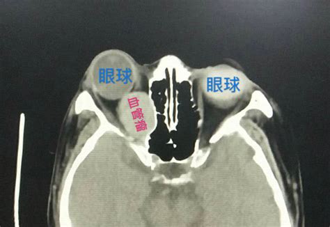 眼眶血管瘤图片 上眼睑有管图片 眼眶肿图片 大山谷图库
