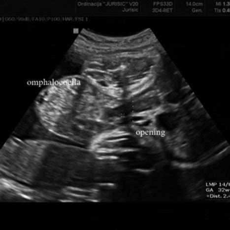 Omphalocele 2d 3d Multislice Ultrasound Download Scientific Diagram
