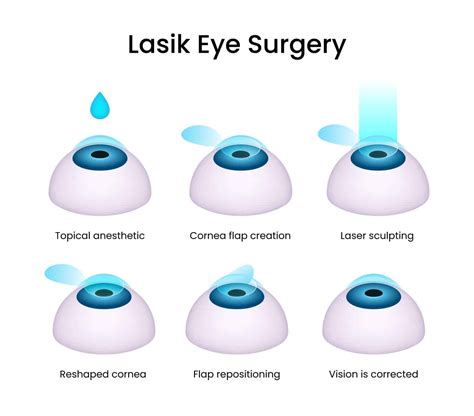 Monovision Lasik One Eye For Distance One For Reading Is It For You