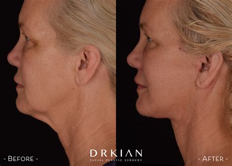 Micro Neck Lift — Dr Kian Micro Neck Lift — Dr Kian