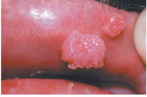 Oral Path Exm 2 Papillary Lesion Flashcards Quizlet