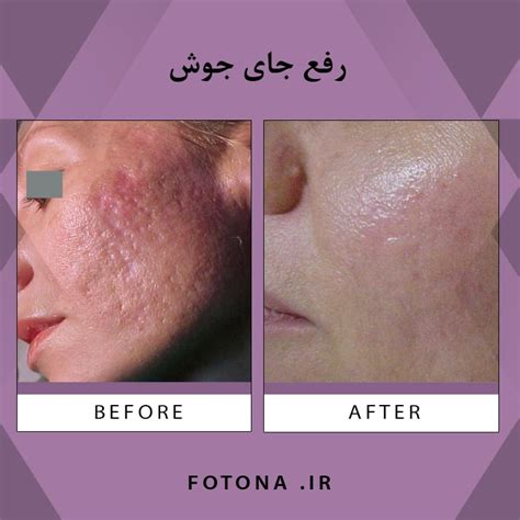درمان جای جوش با لیزر فوتونا قیمت و هزینه