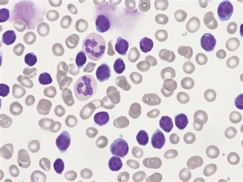 Chronic Lymphocytic Leukaemia Haematological Malignancy Diagnostic Service