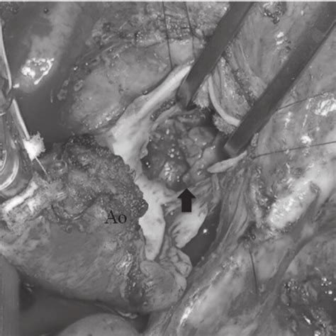 The Surgeons View After Aortotomy And Removal Of The Prosthesis The Download Scientific