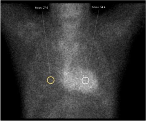 Positive 99mtc Pyp Myocardial Uptake Grade 3 Download Scientific Diagram