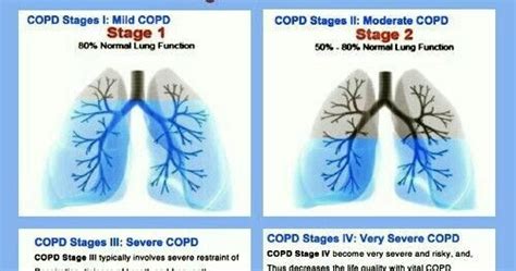 Medical And Health Science Stages Of COPD