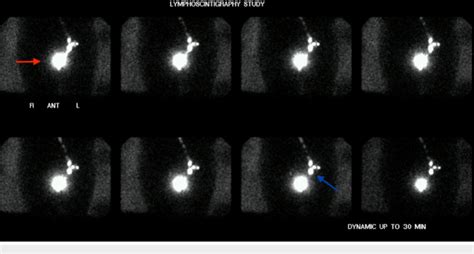 Lymphoscintigraphy Study Anterior Images Injection Of Technetium 99 M
