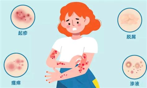 特应性皮炎千万不能拖（ad）