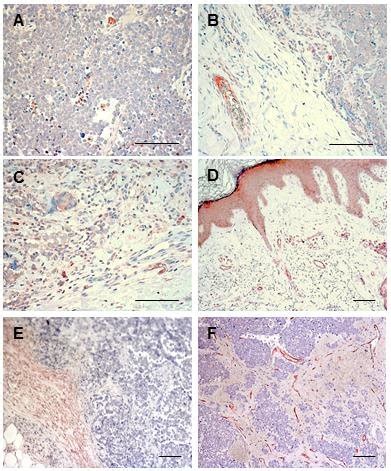Immunohistochemistry Of Merkel Cell Carcinoma Mcc For Angiogenic