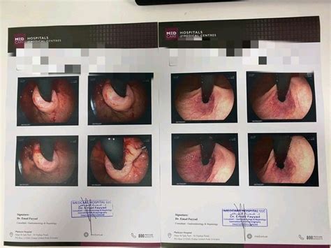 Gerdx Hospital Surgery Reflux Gerd Heartburn Dubai Medcare