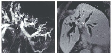 Cholangiocarcinoma Klatskin Tumor A Magnetic Resonance Download Scientific Diagram