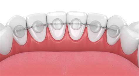 Types Of Retainers For Bottom Teeth At Hudson Facy Blog