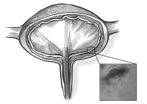 Cystoscope In The Bladder Media Asset Niddk