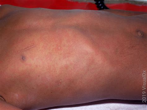 Rubella Vs Rubeola Measles Differences Photos And More Goodrx