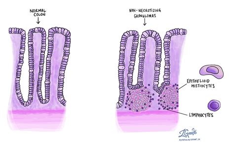 Crohns Disease Pathology Dictionary Mypathologyreportca
