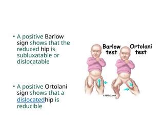 Congenital Hip Dysplasia Involving Subluxation Pptx